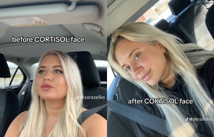 You're Not Overweight, You Just Have Cortisol Face - Here's What You ...